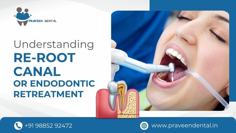 Understanding Re-root Canal Or Endodontic Retreatment